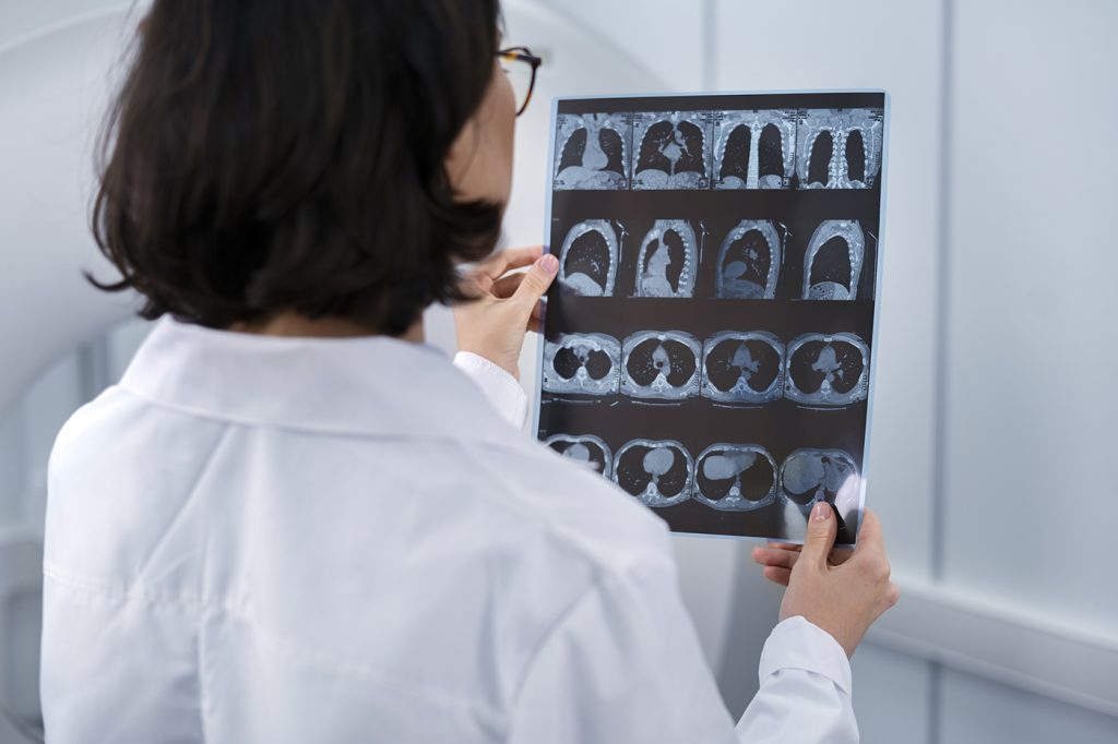 Lung Cancer Recurrence: Rates, Symptoms & Treatments