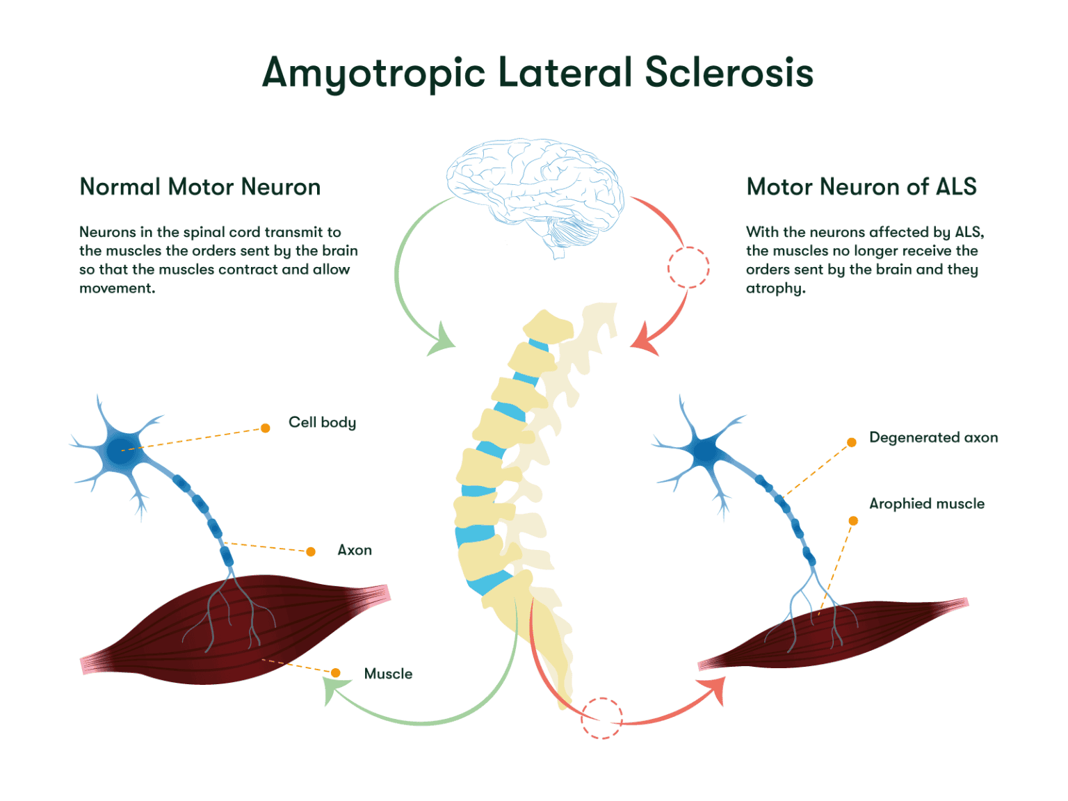 ALS Basics: A Guide to Understanding the Disease
